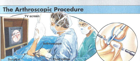Shoulder Arthroscopy & Impingement | Dr Skedros Orthopaedics